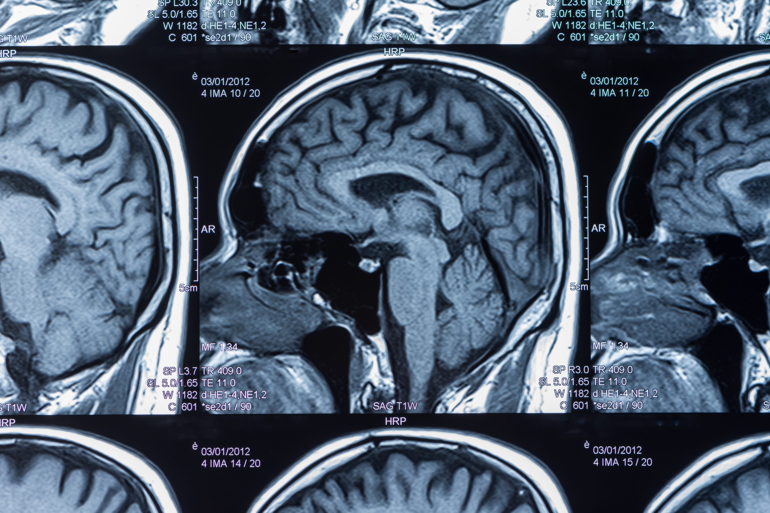 What your skull bones have to do with EAR PRESSURE - Advanced ENT ...